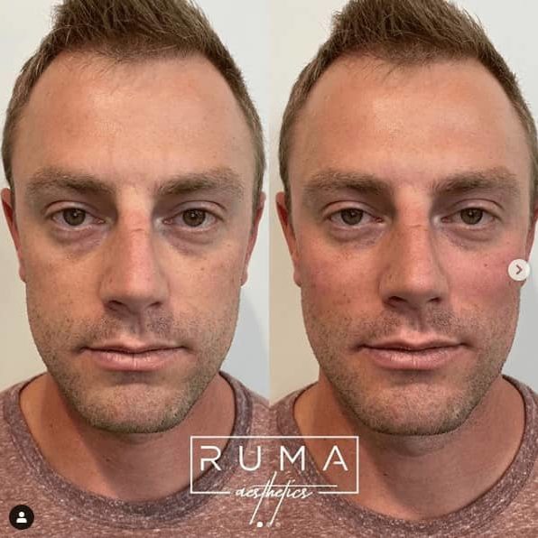 Signature Treatment Before And After Images | Ruma Medical
